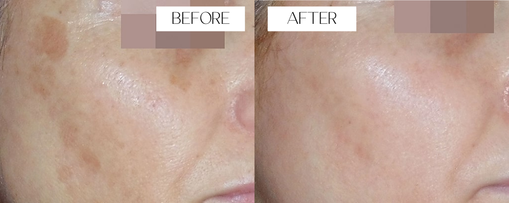 Cosmelan De-Pigmentation Treatment – Rachel Lavelle